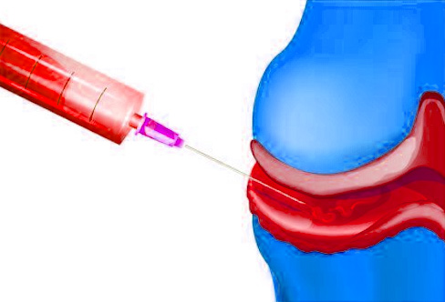 Visco-supplementation Injections HIP KNEE SURGEON, 41% OFF