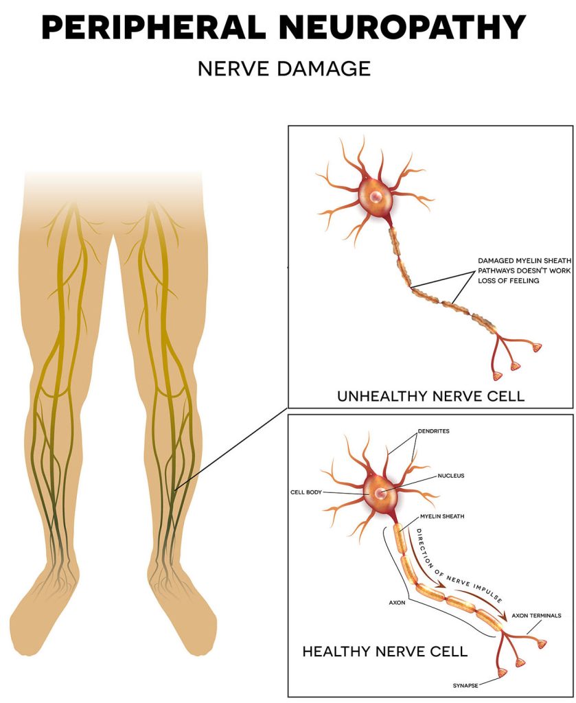 Neuropathy Treatment Specialists - Downtown Pain Physicians NYC